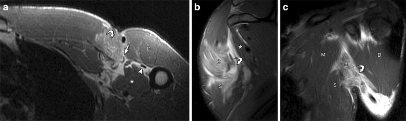 Pectoralis major tears: anatomy, classification, and diagnosis with ...