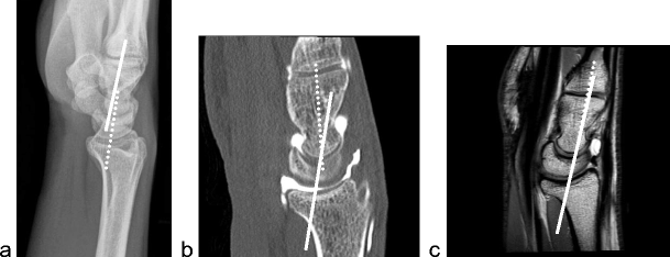 Carpal angles as measured on CT and MRI: can we simply translate ...