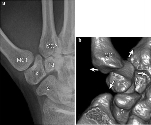 Imaging and management of thumb carpometacarpal joint osteoarthritis ...