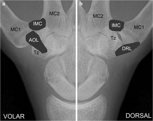 Imaging and management of thumb carpometacarpal joint osteoarthritis ...