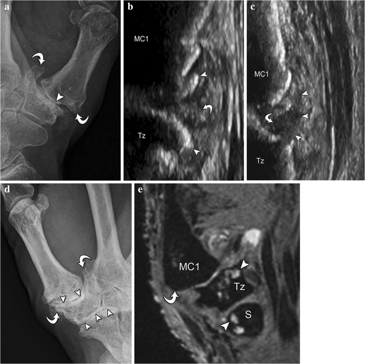 Imaging and management of thumb carpometacarpal joint osteoarthritis ...