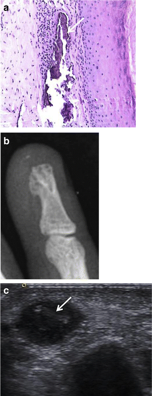 Benign soft-tissue lesions of the fingers: radiopathological ...