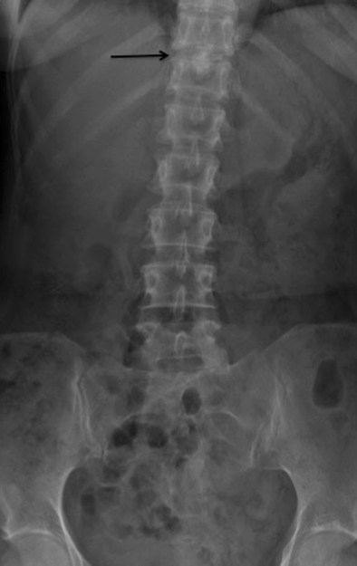 Acute symptomatic calcific discitis in adults: a case report and review ...