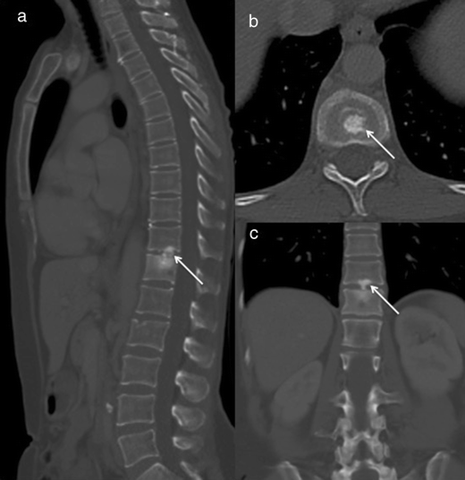 Acute symptomatic calcific discitis in adults: a case report and review ...