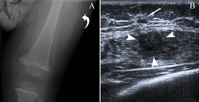 Vaccine-induced myositis with intramuscular sterile abscess formation ...