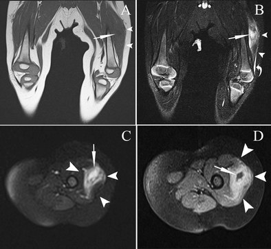 Vaccine-induced myositis with intramuscular sterile abscess formation ...