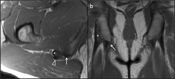 The adductor magnus “mini-hamstring”: MRI appearance and potential ...