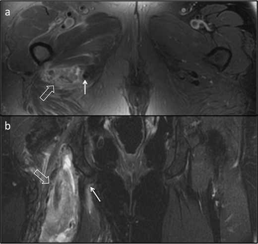 The adductor magnus “mini-hamstring”: MRI appearance and potential ...
