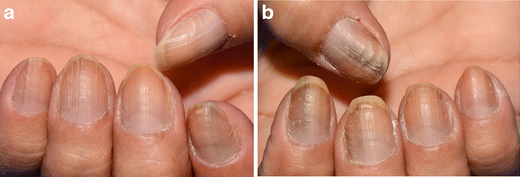 Sarcoidosis: radiographic manifestations in the nails and distal ...