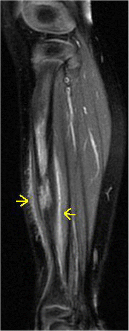 MRI and clinical features of Langerhans cell histiocytosis (LCH) in the ...