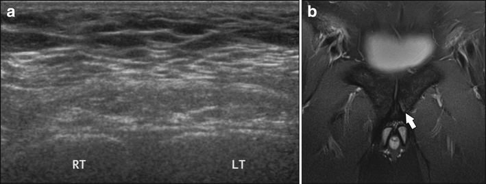 Sonographic evaluation of athletic pubalgia | SpringerLink