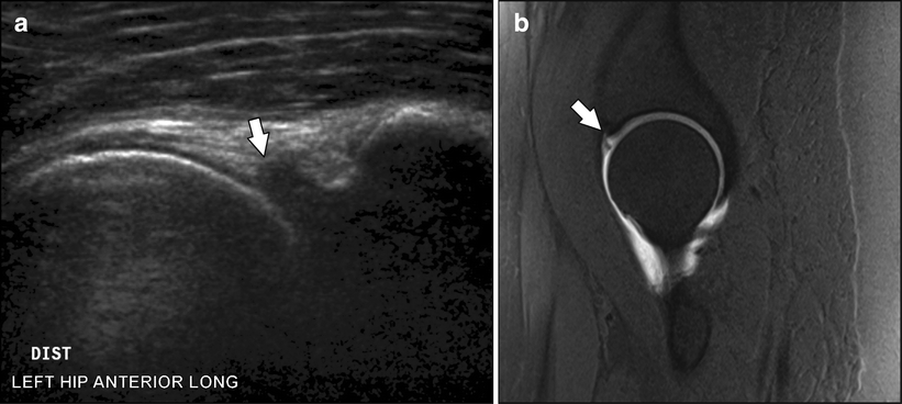 Sonographic evaluation of athletic pubalgia | SpringerLink