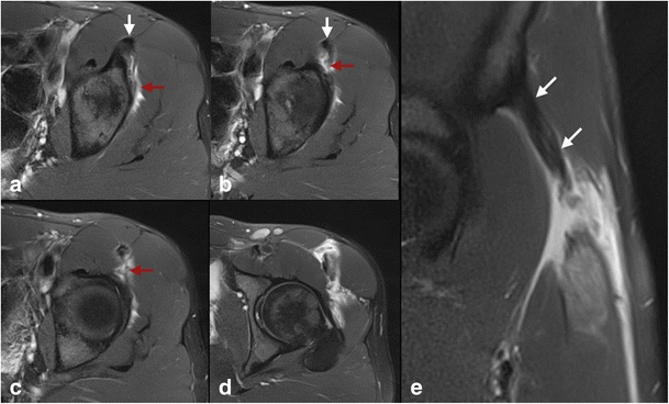 Imaging of rectus femoris proximal tendinopathies | SpringerLink