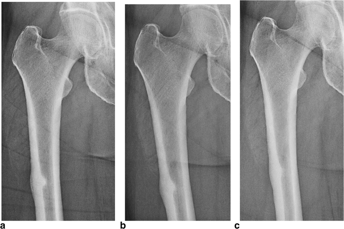 Long-term radiographic follow-up of bisphosphonate-associated atypical ...
