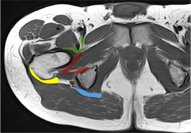 Evaluation and management of ischiofemoral impingement: a ...