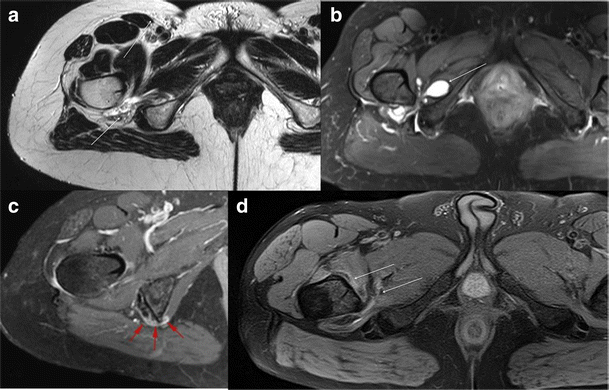 Evaluation and management of ischiofemoral impingement: a ...