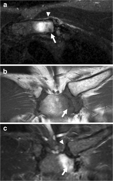 Manubrial stress fractures diagnosed on MRI: report of two cases and ...