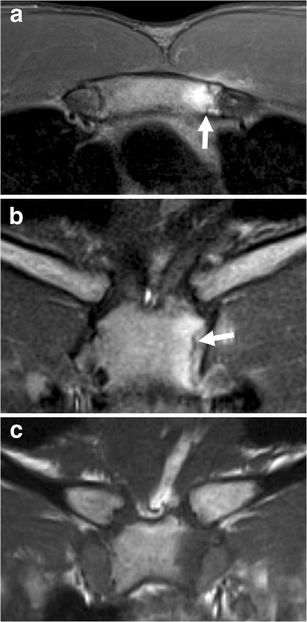 Manubrial stress fractures diagnosed on MRI: report of two cases and ...