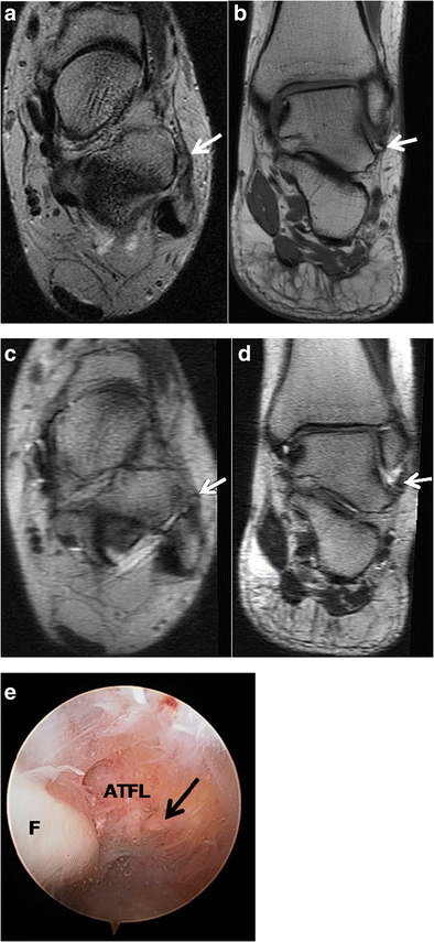 MRI of the anterior talofibular ligament, talar cartilage and os ...