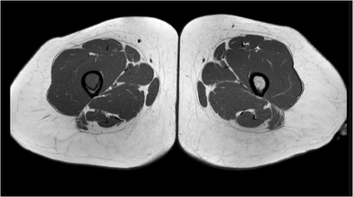 Lumps in the thigh | SpringerLink