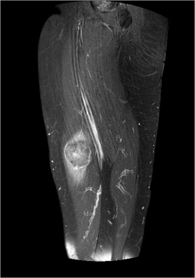 Lumps in the thigh | SpringerLink