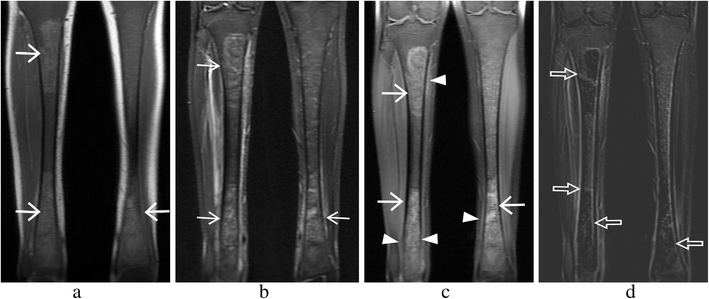 Acute bone infarction: a rare complication in thalassemia | SpringerLink