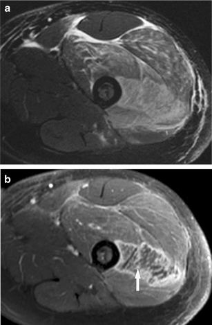 Acute myonecrosis on MRI: etiologies in an oncological cohort and ...