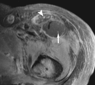 Acute myonecrosis on MRI: etiologies in an oncological cohort and ...