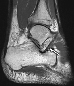 The frondiform ligament and pseudotenosynovitis of the extensor ...