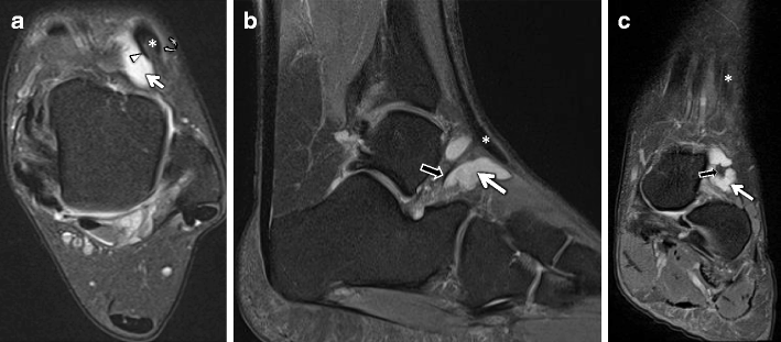 The frondiform ligament and pseudotenosynovitis of the extensor ...