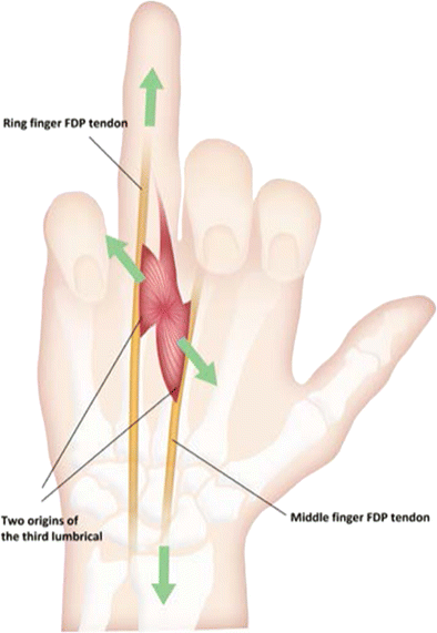 Ring finger lumbrical origin strain: a case series with imaging ...