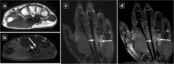 MRI in flexor tendon rupture after collagenase injection | SpringerLink