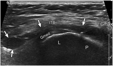 Ultrasound evaluation of bursae: anatomy and pathological appearances ...