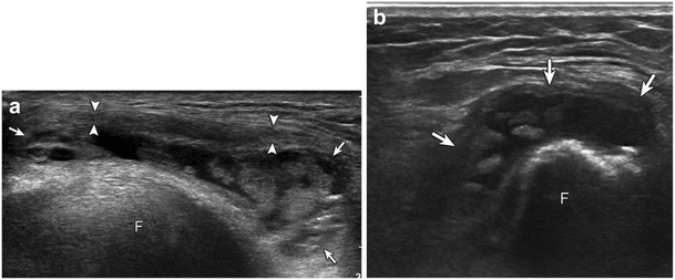 Ultrasound evaluation of bursae: anatomy and pathological appearances ...