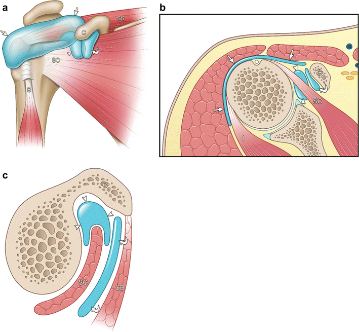 Ultrasound evaluation of bursae: anatomy and pathological appearances ...