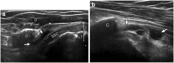 Ultrasound evaluation of bursae: anatomy and pathological appearances ...
