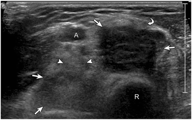 Ultrasound evaluation of bursae: anatomy and pathological appearances ...