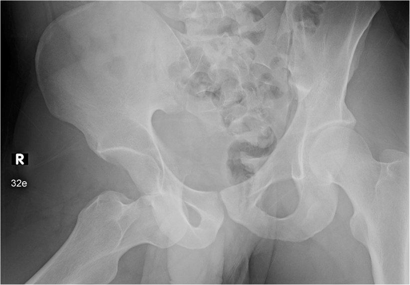Imaging findings of anterior hip dislocations | SpringerLink