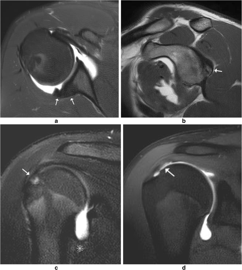 Pathologies of the shoulder and elbow affecting the overhead throwing ...