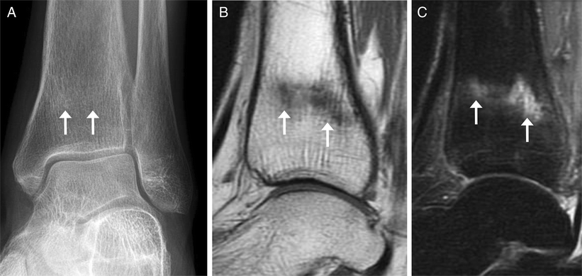 Stress fractures of the foot and ankle, part 2: site-specific etiology ...