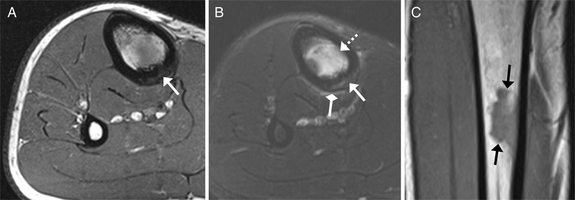 Stress fractures of the foot and ankle, part 2: site-specific etiology ...