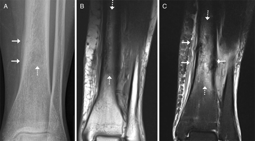 Stress fractures of the foot and ankle, part 2: site-specific etiology ...
