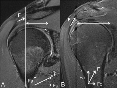 Multimodality imaging of subacromial impingement syndrome | SpringerLink