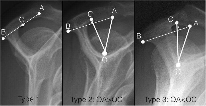 Multimodality imaging of subacromial impingement syndrome | SpringerLink