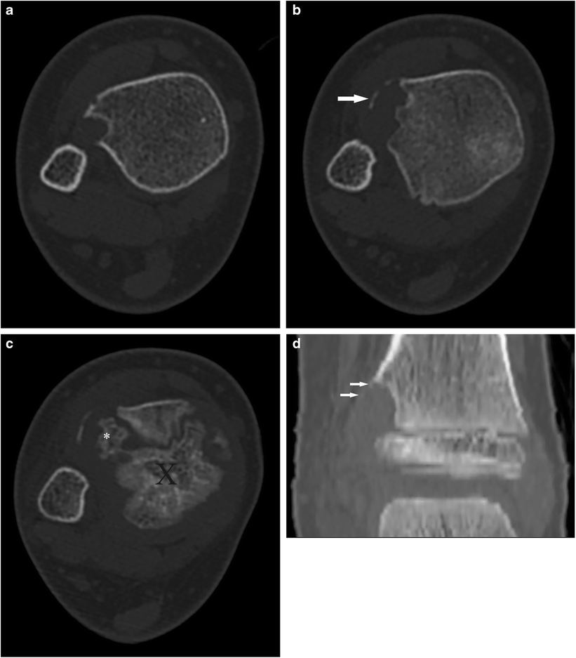 Epiphyseal hyperplasia caused by an ectopic ossification center of the ...