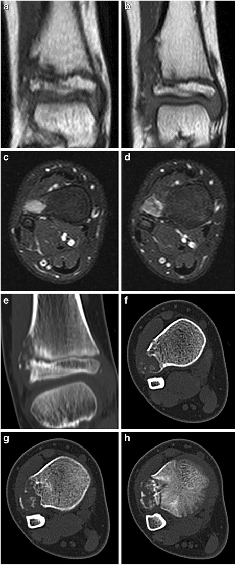 Epiphyseal hyperplasia caused by an ectopic ossification center of the ...