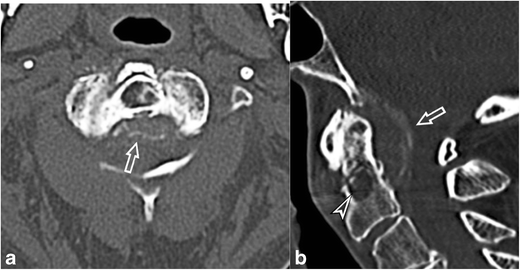Non-union rate of type II and III odontoid fractures in CPPD versus a ...