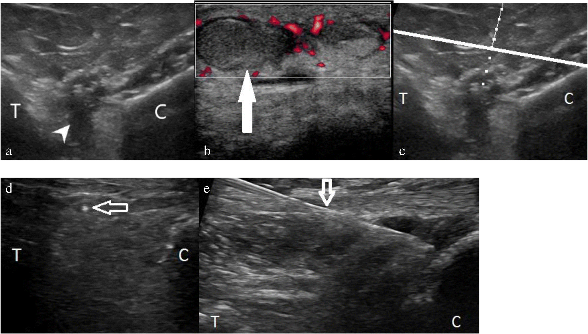 Sonographic and radiographic findings of posterior tibial tendon ...