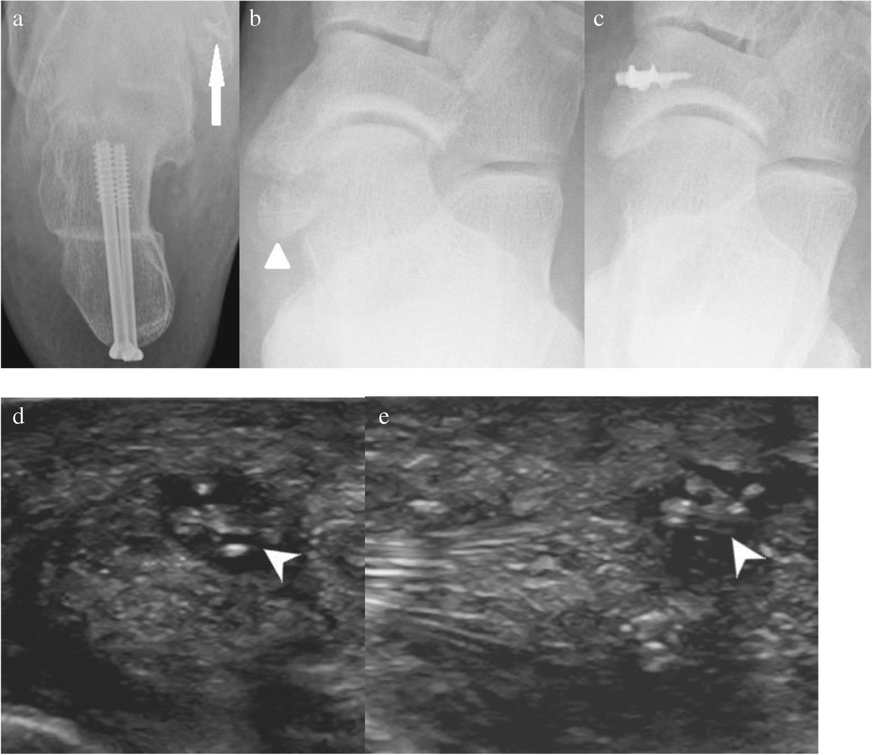 Sonographic and radiographic findings of posterior tibial tendon ...