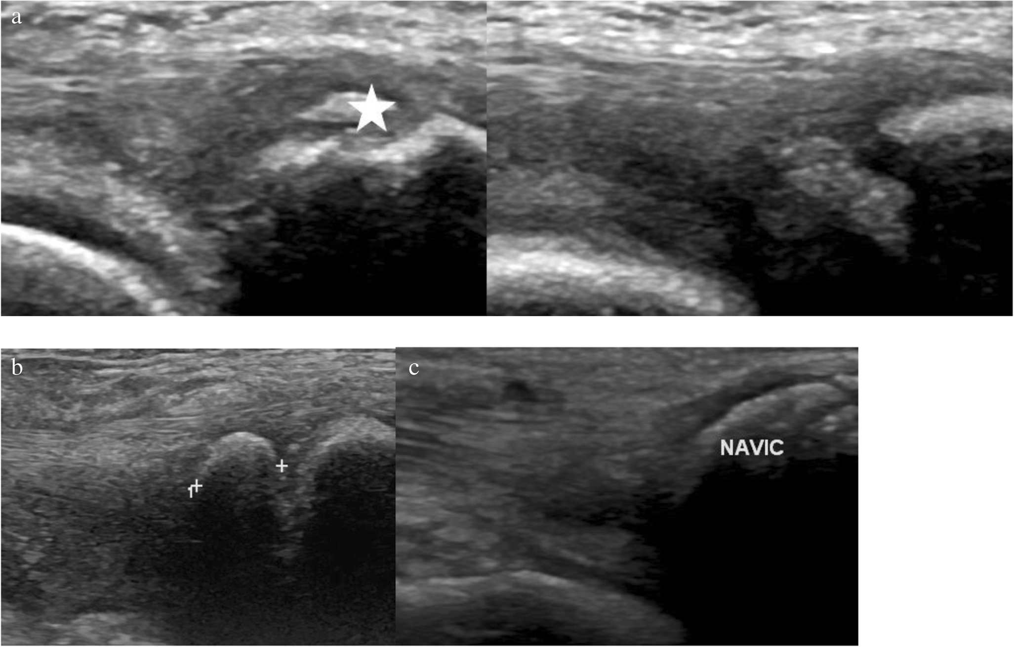 Sonographic and radiographic findings of posterior tibial tendon ...